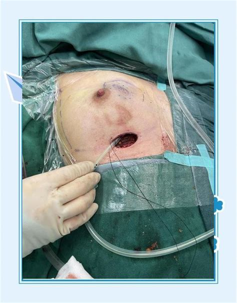 乳腺结节微创手术：没那么疼，真的！