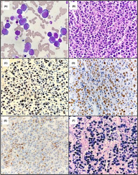 Plasmablastic Lymphoma An Update Pmc