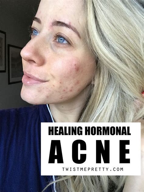 My Anti Aging Acne Prone SKINCARE Routine Twist Me Pretty Cystic Acne Treatment Hormonal