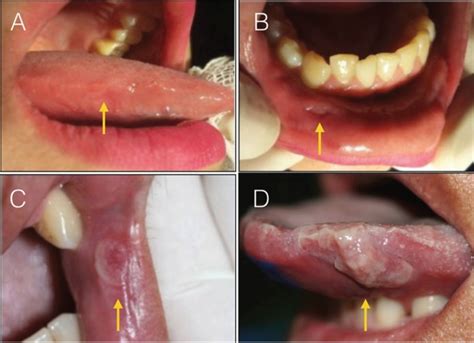 Oral Findings In Secondary Syphilis Pmc