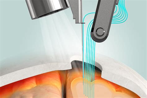 Neuralink What You Need To Know About The New Brain Implant