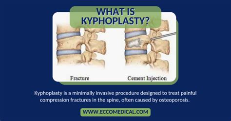 Is Kyphoplasty Right For You Non Surgical Relief For Spinal Compression Fractures Ecoo Medical