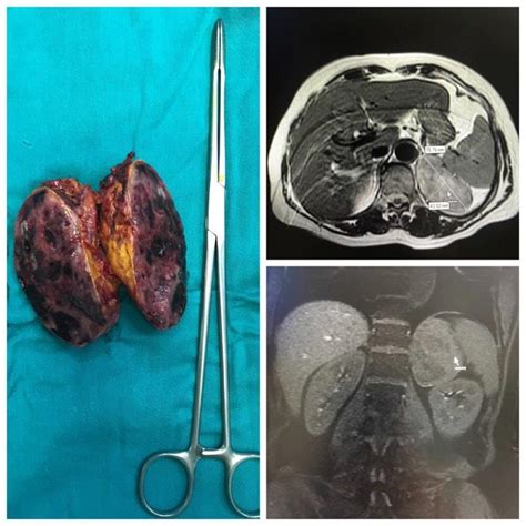 Лява надбъбречна жлеза с феохромоцитом премахната вчера 09 11 17г чрез миниинвазивна