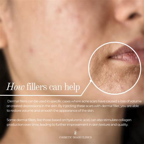 Understanding Acne Types Causes And Effective Treatments Cosmetic Image Clinics