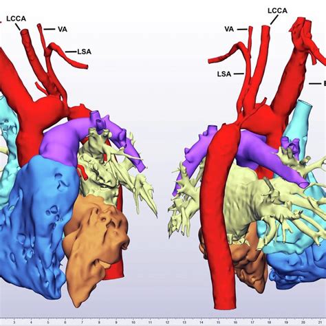 Three Dimensional Model Reconstruction Of Preoperative Computed Download Scientific Diagram