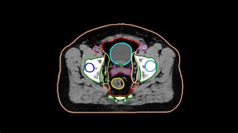 Autocontouring In Radiation Therapy Siemens Healthineers Siemens Healthineers