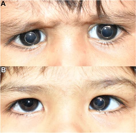 Looking Through The Glass Microspherophakia With Ltbp2 Mutation In Siblings Ophthalmology