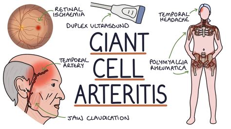 Symptoms Of Arterial Arteritis