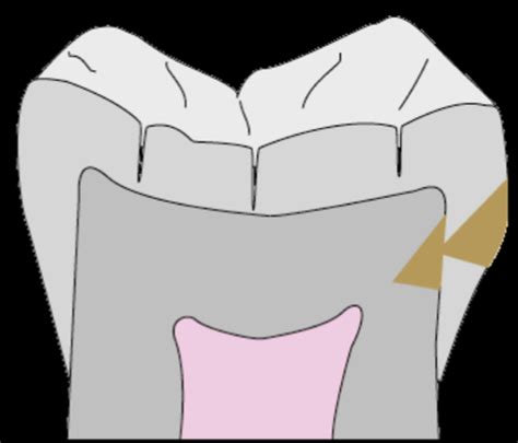 Microanatomy Of Caries And Operative Considerations For Caries Management Flashcards Quizlet