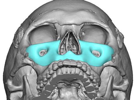 The Different Types Of Custom Mask Implants For Aesthetic Midface