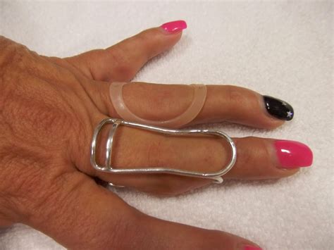 Rheumatologe Correcting Swan Neck Deformity In An Elegant Way