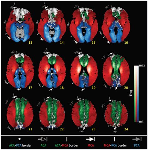 Cerebral Vascular Territories