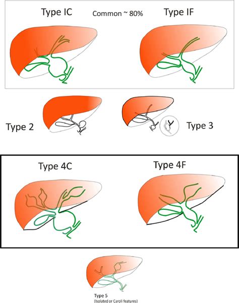 Kings College Hospital Classification Of Choledochal Malformation