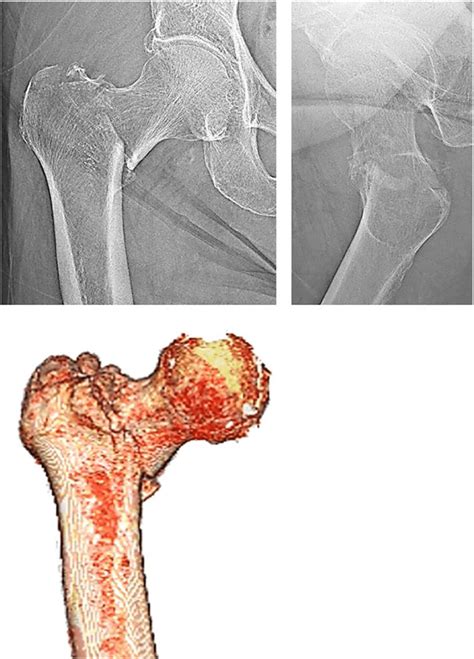 Right Basicervical Femoral Fracture Download Scientific Diagram