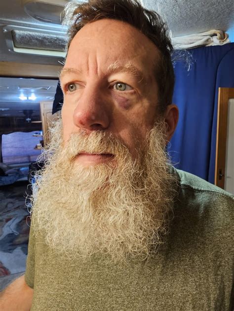 Finally Joined The Got Fucked Up By A Seizure Group Repilepsy