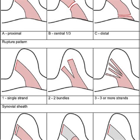 Three Digit Acl Rupture Classification The First Digit Describes The Download Scientific