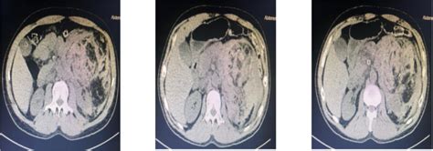 Ct Scan Of The Abdomen And Pelvis Without Contrast Showing Left Renal