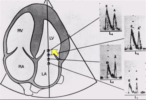 Assessing Lv Diastolic Function Flashcards Quizlet