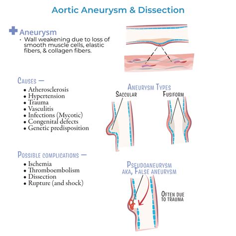 Clinical Pathology Glossary Aortic Aneurysm And Dissection Ditki Medical And Biological Sciences