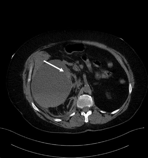 A Dense Nodule Was Noted On The Medial Surface Of The Cyst Arrow Download Scientific