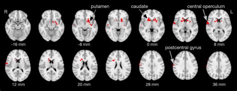 Regions Of Increased Functional Connectivity In Adults With Adhd With Download Scientific