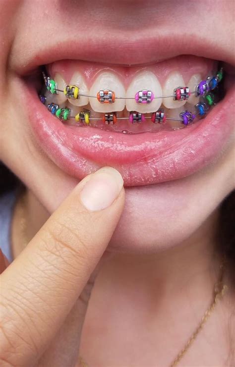 Эрдэнэт шүдний аппарат шүдний аппарат сонирхогчдын групп Facebook