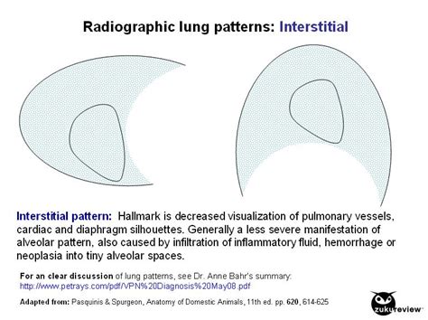2 Interstitial Pattern Characterized By Decreased Visualization Of