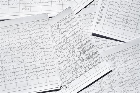 Premium Photo Electroencephalogram Diagnostic Rezults After Epilepsy