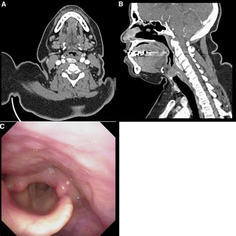 Transoral Robotic Resection Of A Retropharyngeal Parathyroid Adenoma A Case Report Request Pdf