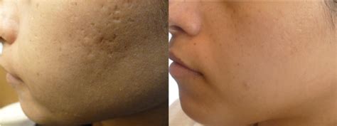 Acne Ice Pick Scarring Holes Dermatologist In Brooklyn Ny