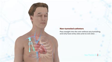 Non Tunneled Catheter Peripherally Inserted Central Catheters Versus