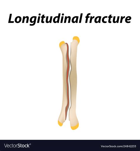Longitudinal Bone Fracture Infographics Royalty Free Vector