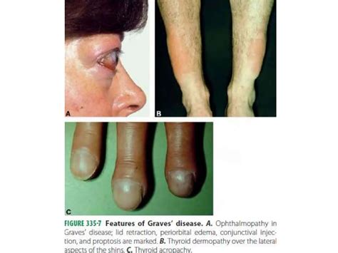 Hyperthyroidism Ppt Pptx