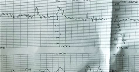 Note Alternative Periods Of Normal And Reduced Baseline Variability