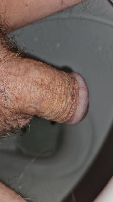 More Farty Diarrohea