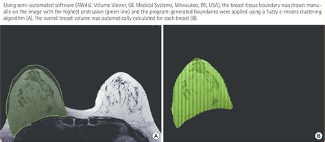 Magnetic Resonance Imaging Based Volumetry Download Scientific Diagram