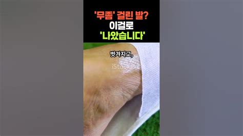 아직도 가려운 발 그대로 무좀을 방치하실건가요 Youtube