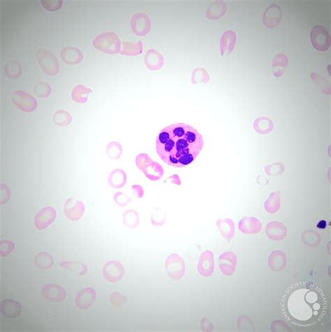 Hypersegmented Neutrophil