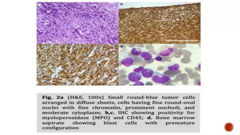 Myeloid Sarcoma Pptx