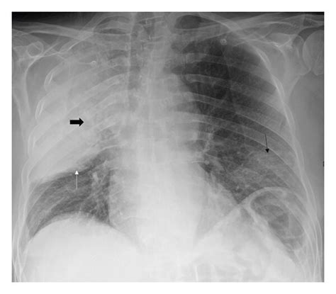Types Of Consolidation Chest X Ray At Alfredo Grove Blog
