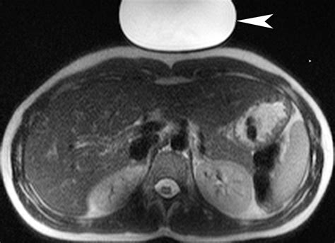 Abdominal Mr Imaging At 3 0 T Radiographics