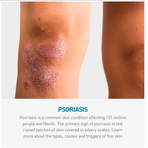 Cerave Psoriasis Moisturizing Cream With Salicylic Acid 8oz