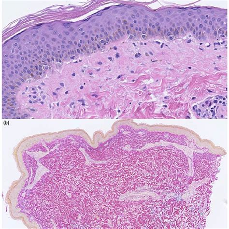 Skin Histopathology A Early Vacuolar Degeneration Of Basal Epidermal