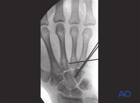 Reduction Immobilization For Dislocation And Fracture Dislocation Of