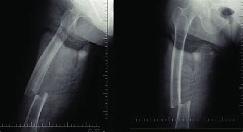Right Femur Displaced Fracture Download Scientific Diagram