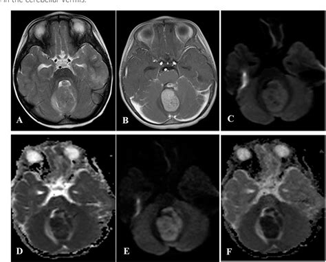 Table 1 From A Comparison Of High B Value Vs Standard B Value Diffusion Weighted Magnetic