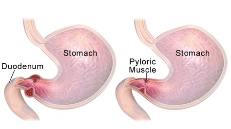 What Does Pyloric Stenosis Vomit Look Like At Bernice Astle Blog