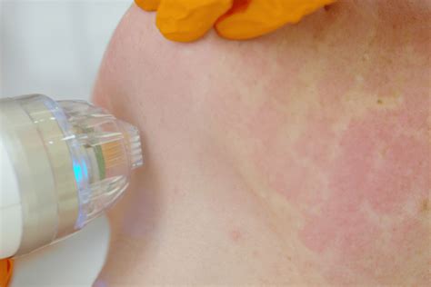 Rf Microneedling Near Me Simcoe Cosmetic Clinic In Ontario
