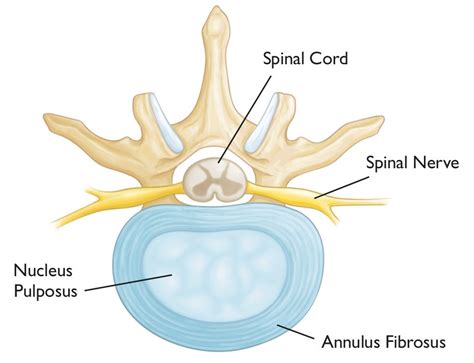 Intervertebral Disc Herniation