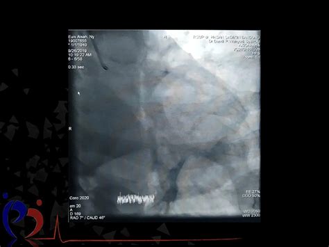 Case Myocardial Infarction Type Two Pptx